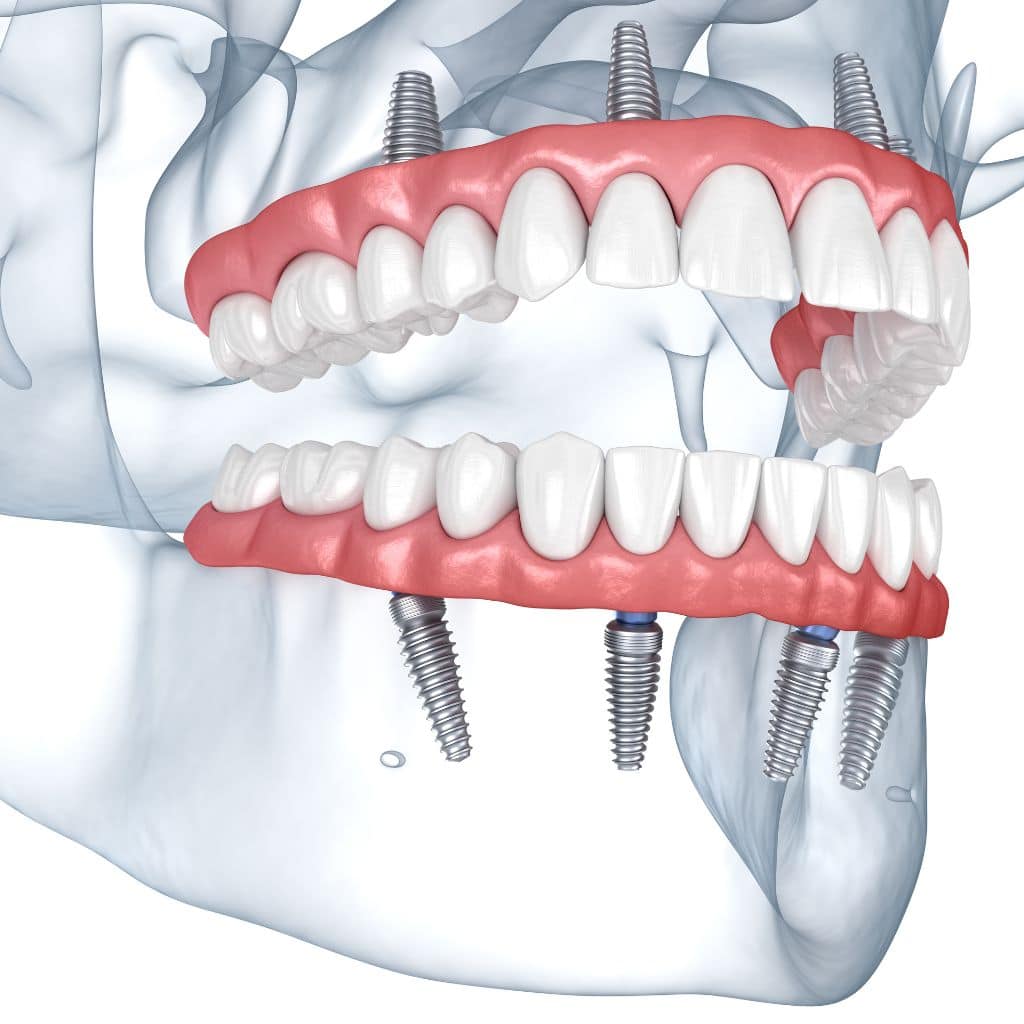 All-on-4 Implants Las Vegas - Smiles for Life