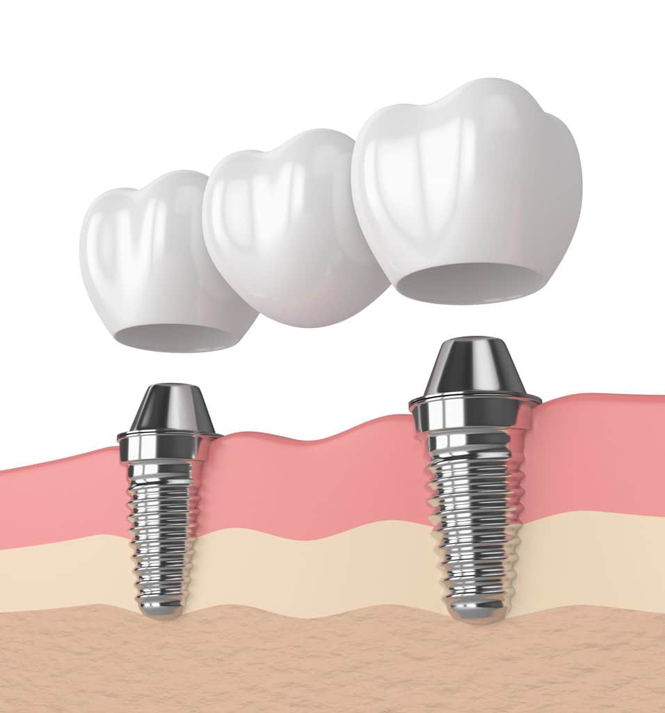 Implant-Supported Bridges | Smiles for Life Las Vegas
